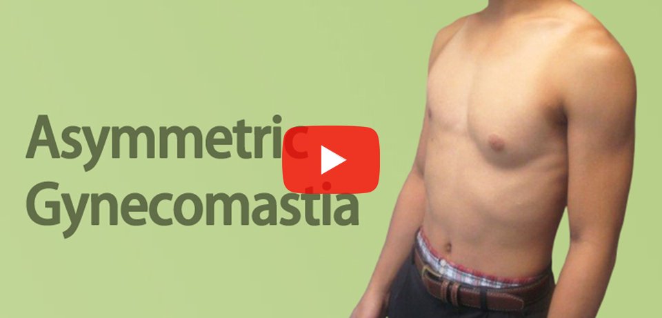 Asymmetric Gynecomastia