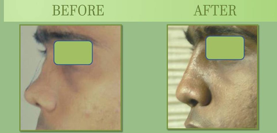 Nasoethmoid Fractures